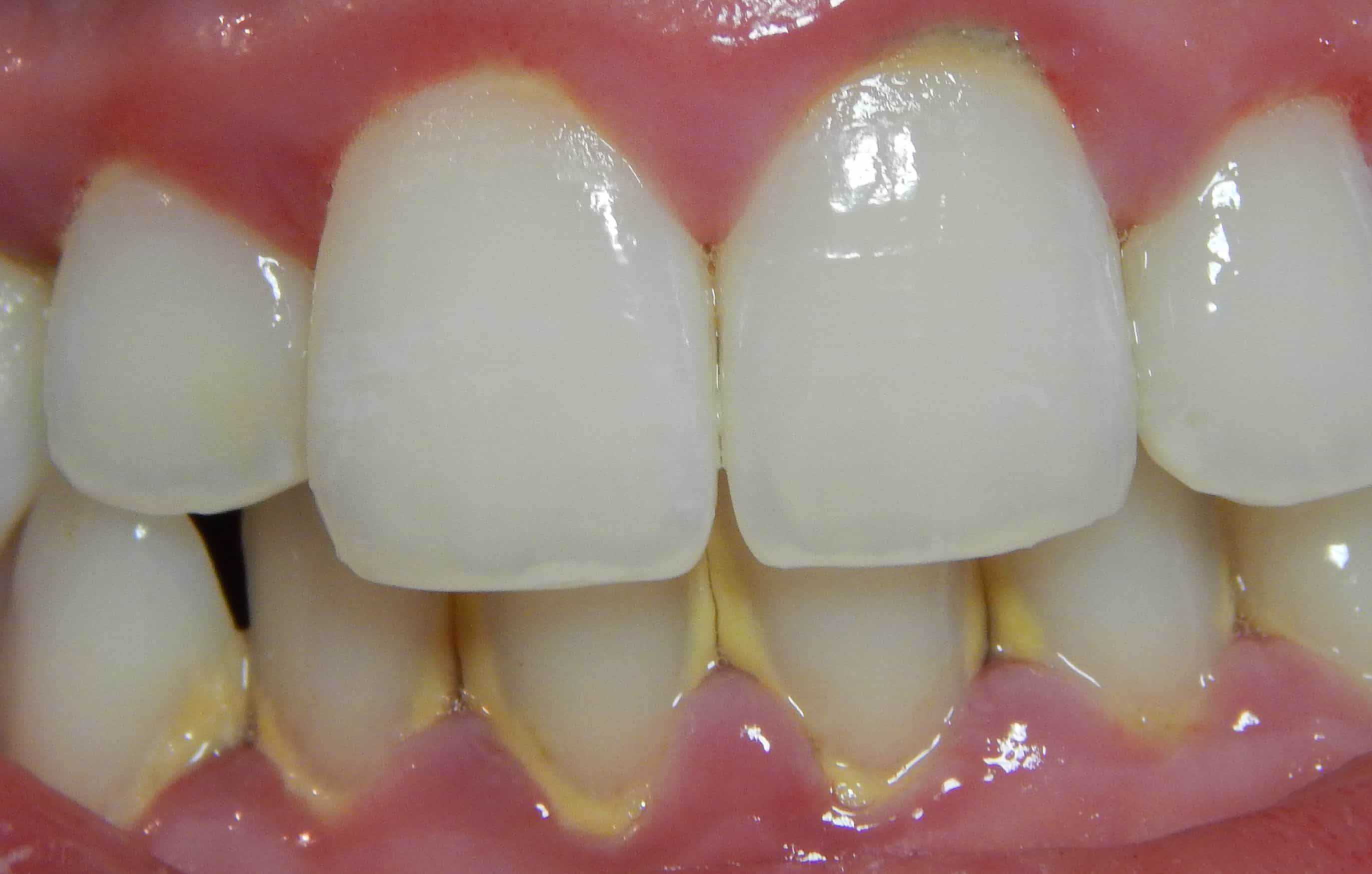 Qué causa el sarro en los dientes y cómo evitarlo | Clínica Dental Urbina