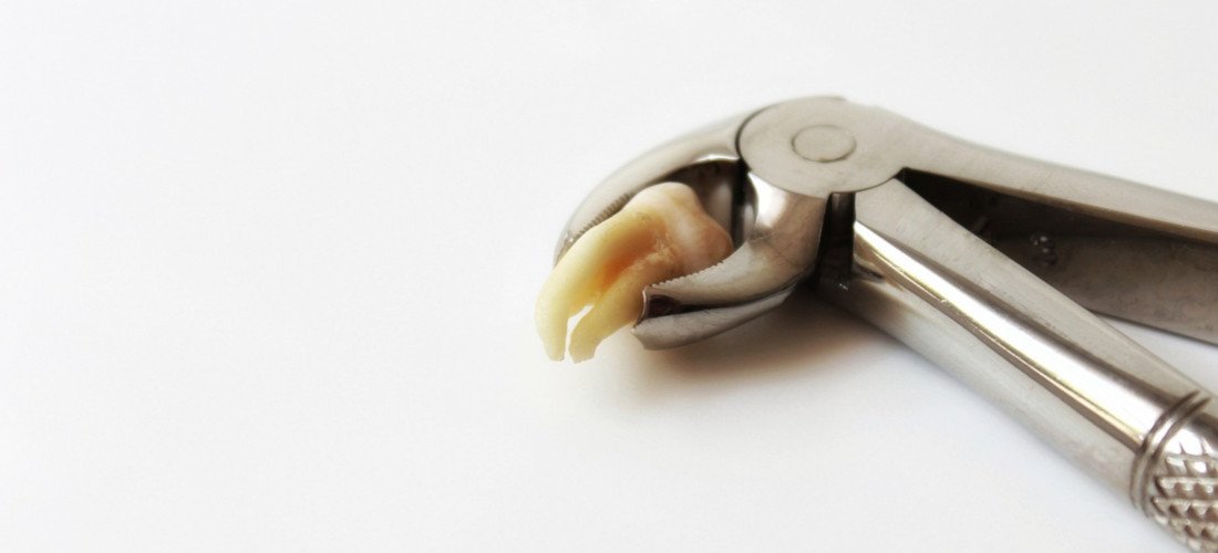 Cuidados después de la extracción de las muelas del juicio