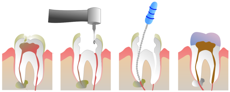 ¿Cómo matar el nervio de un diente o una muela? | Clínica Dental
